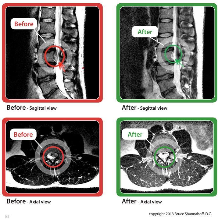 Lumbar Non surgical Spinal Decompression In Encino CA Lumbar Non surgical Spinal Decompression In Encino CA